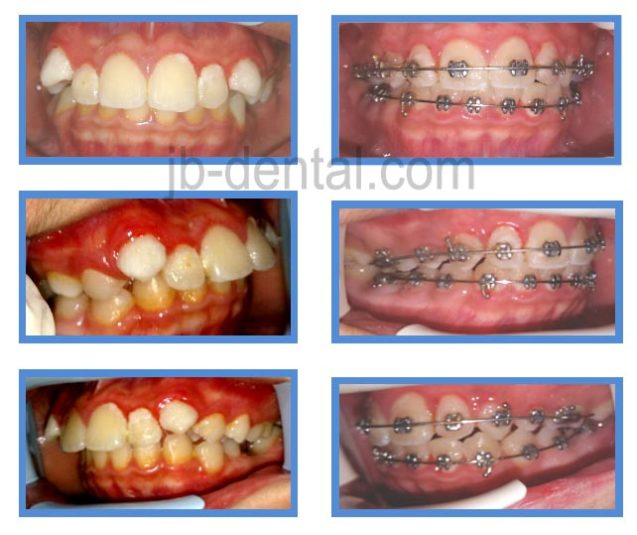 BEFORE AND AFTER – Foto SEBELUM dan SESUDAH Perawatan ORTODONTI - JB ...